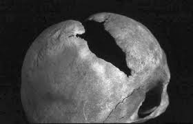 Successful skull trepanation in Neolithic China – Novo Scriptorium