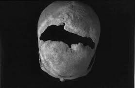 Successful skull trepanation in Neolithic China – Novo Scriptorium